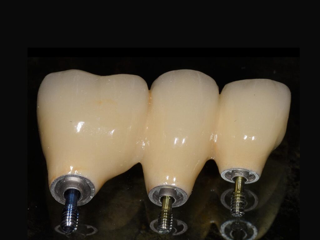 Implant Crown And Bridge - Pink City